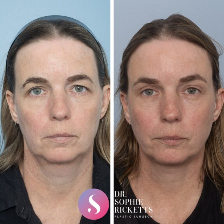 Temporal Brow lift and Upper Blepharoplasty | Dr. Sophie Ricketts ...